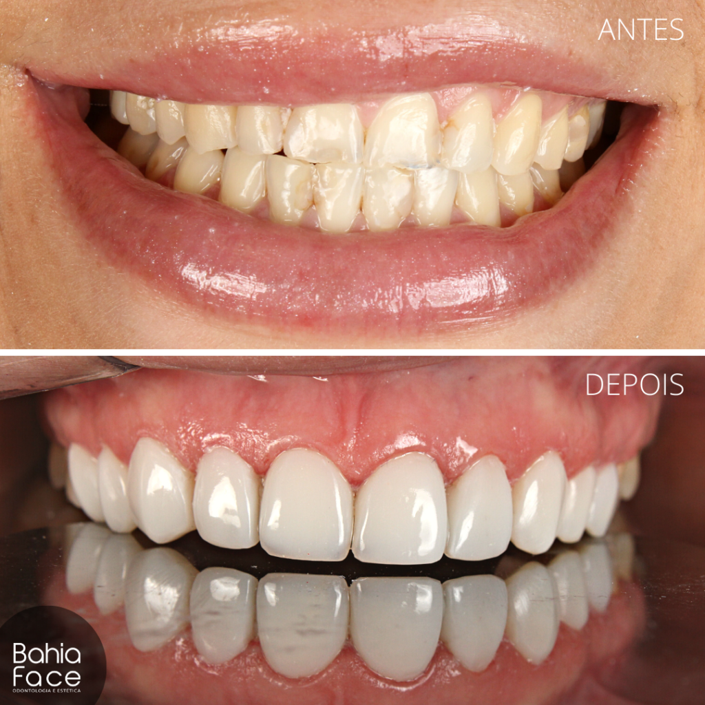 [Serviço] Faceta de resina