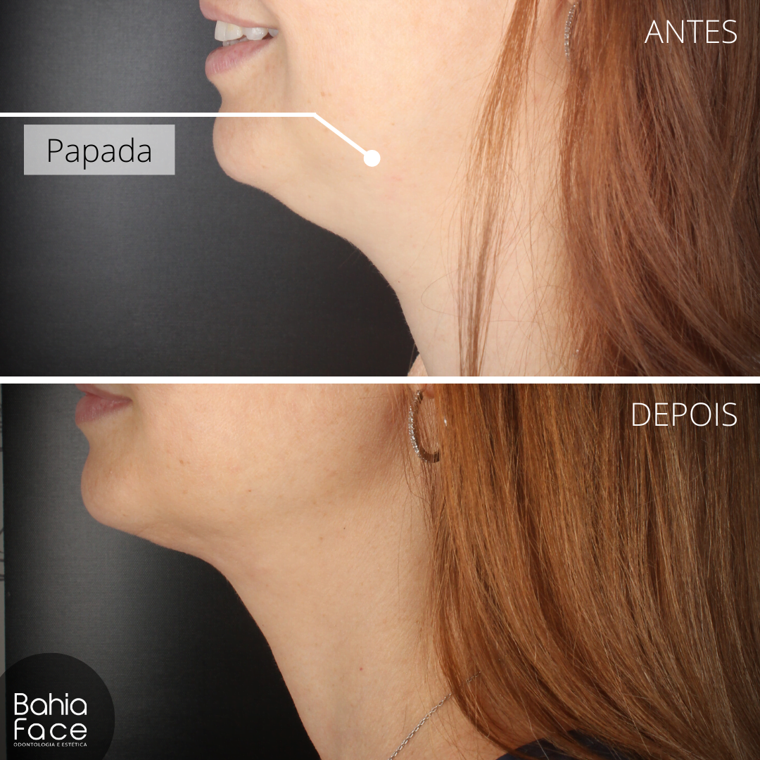 Lipo de Papada | Bahia Face