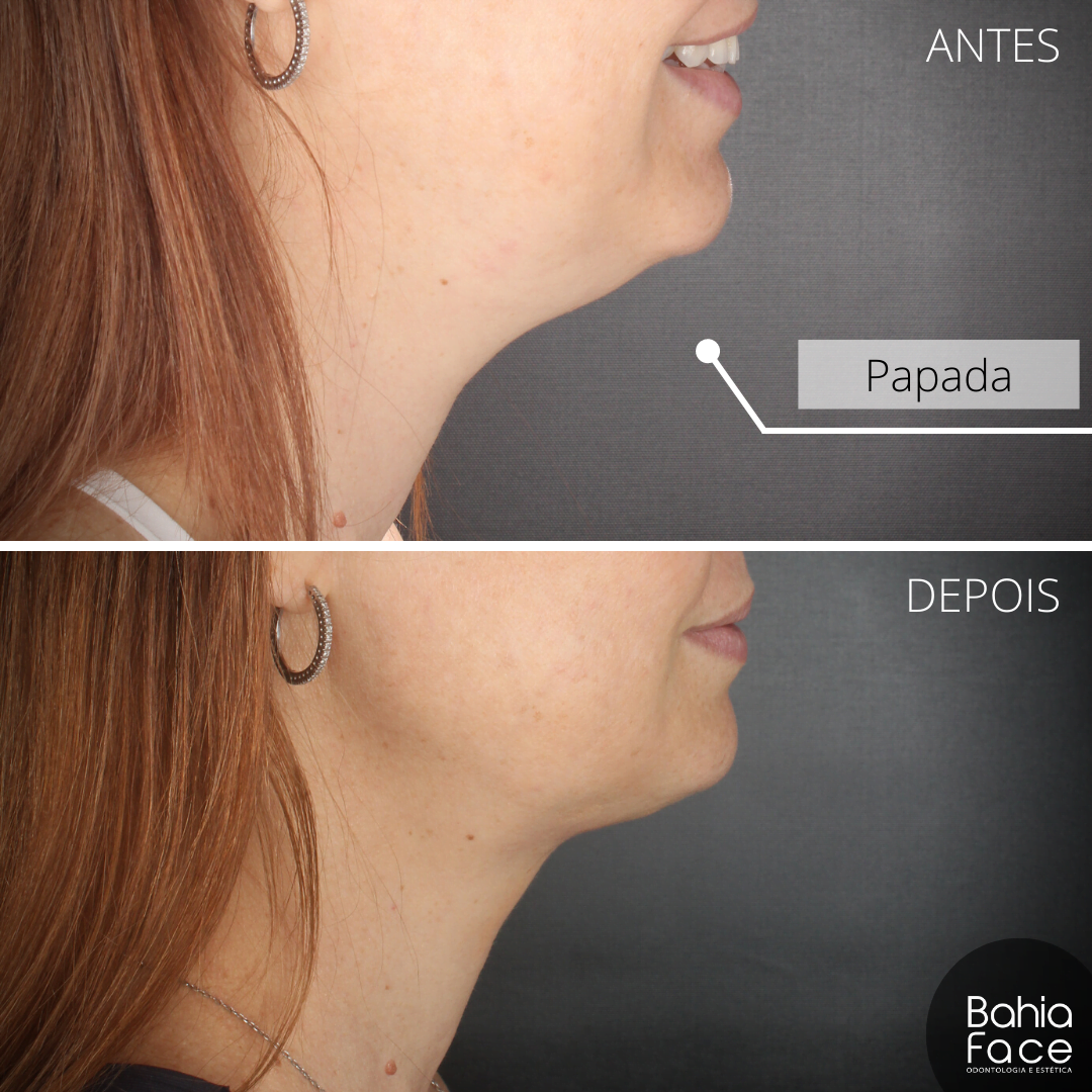 Lipo de Papada | Bahia Face