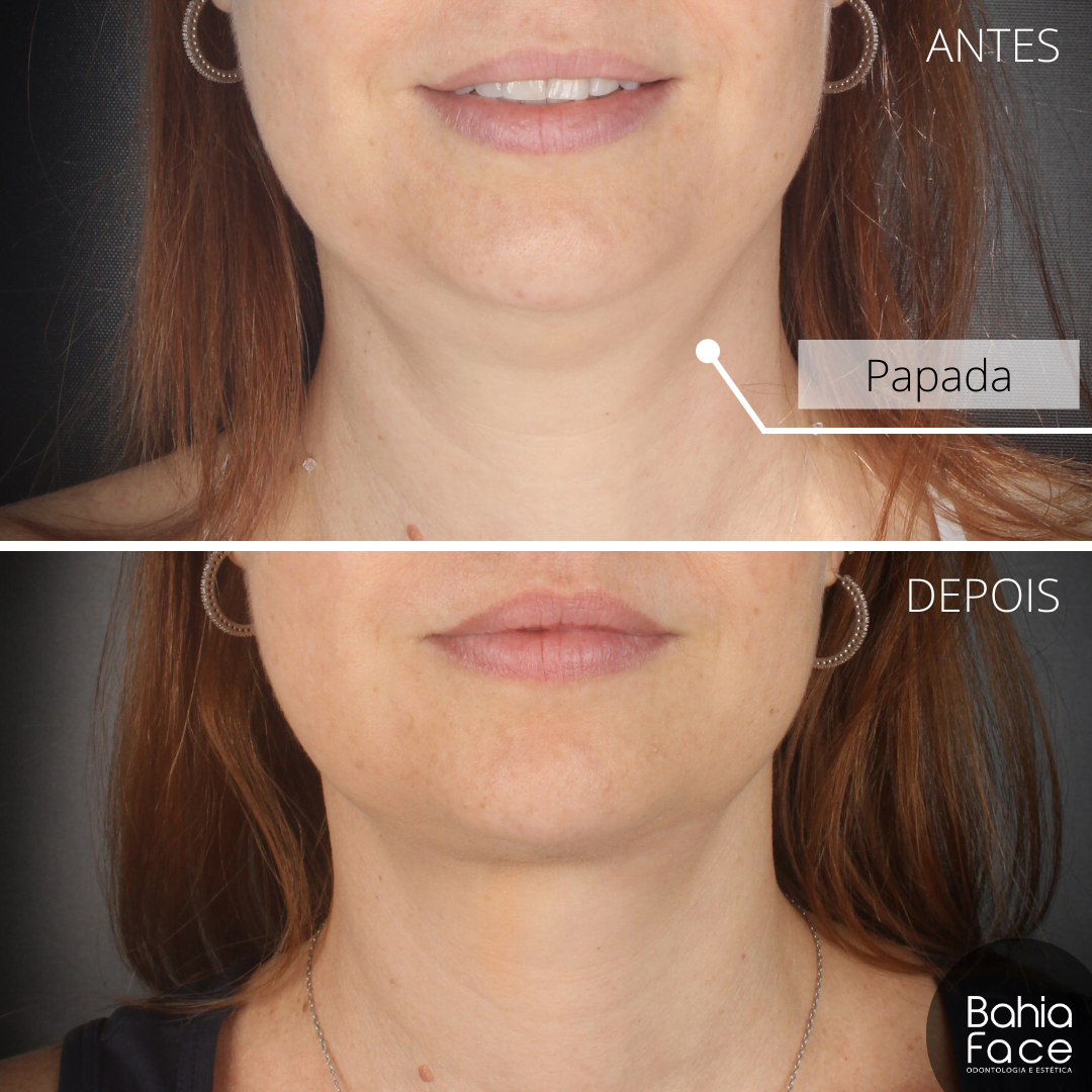 Lipo de Papada | Bahia Face